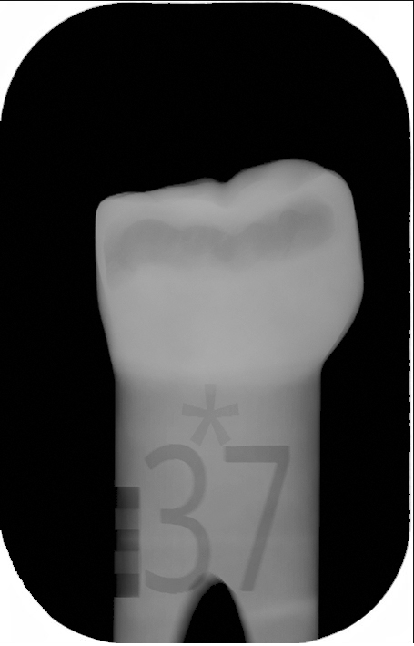 Leeds 3D Printed Model | Leeds Digital Dentistry