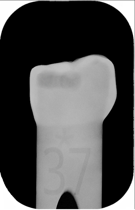 Leeds 3D Printed Model | Leeds Digital Dentistry